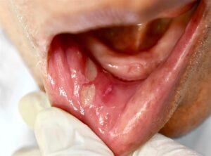 Afty v puse – příčiny, léčba a babské rady - MZ.cz