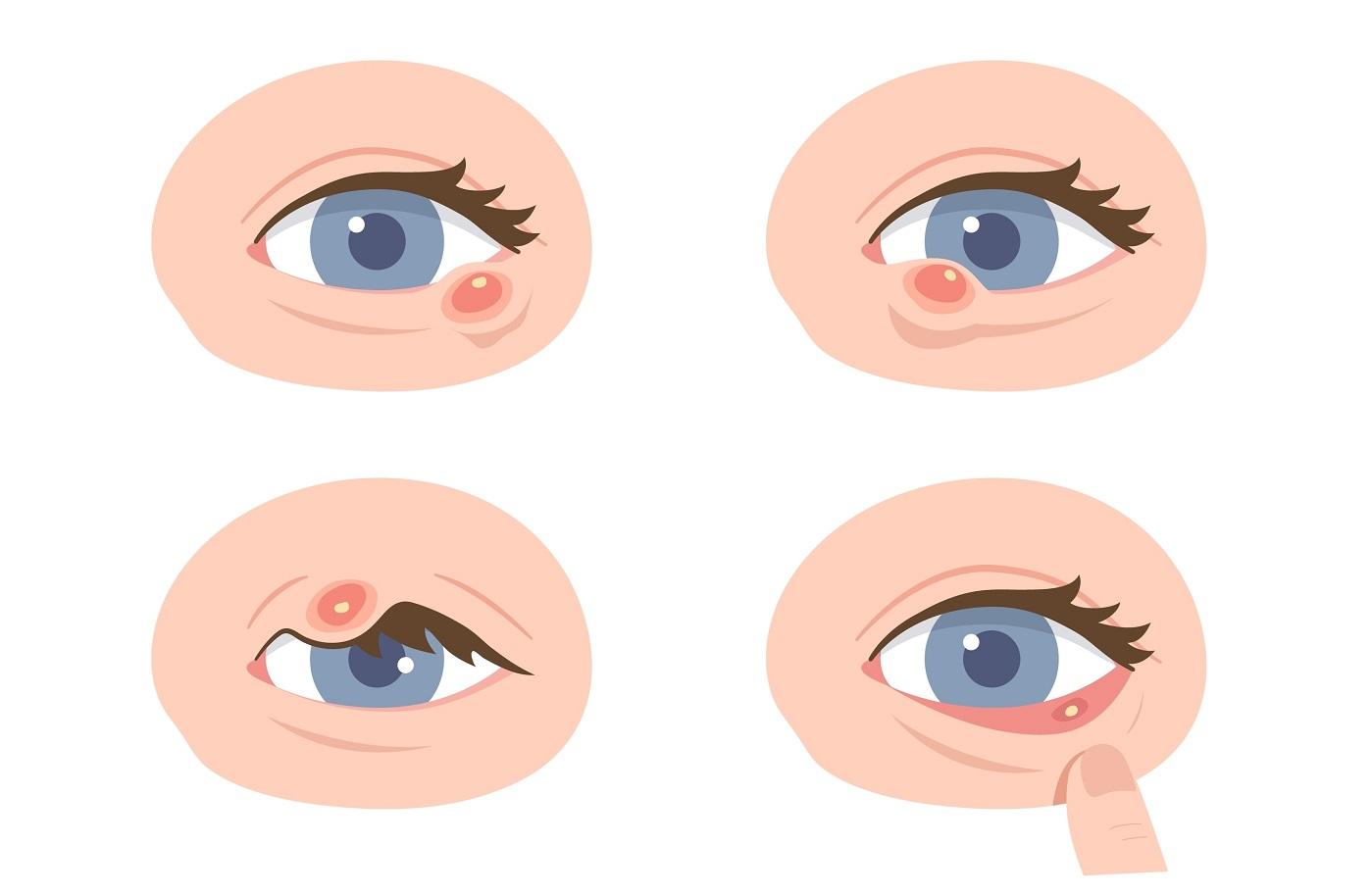 Ječné zrno – příznaky, léčba, babské rady a prevence - MZ.cz